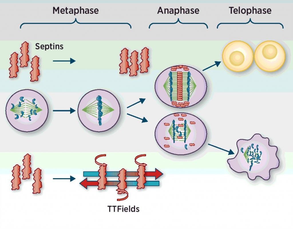Tumor Treating Fields - Creative Diagnostics