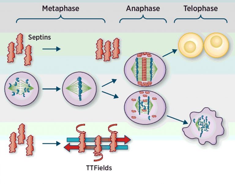 Tumor Treating Fields - Creative Diagnostics
