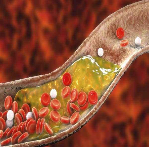 Atherosclerosis - Creative Diagnostics