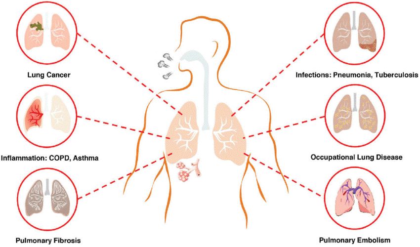 Respiratory Diseases - Creative Diagnostics