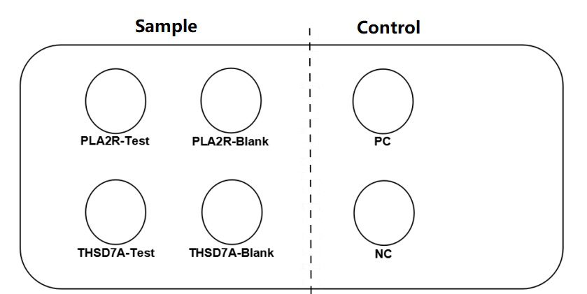 Phospholipase A2 receptor (PLA2R) and THSD7A stable cell line - Creative Diagnostics