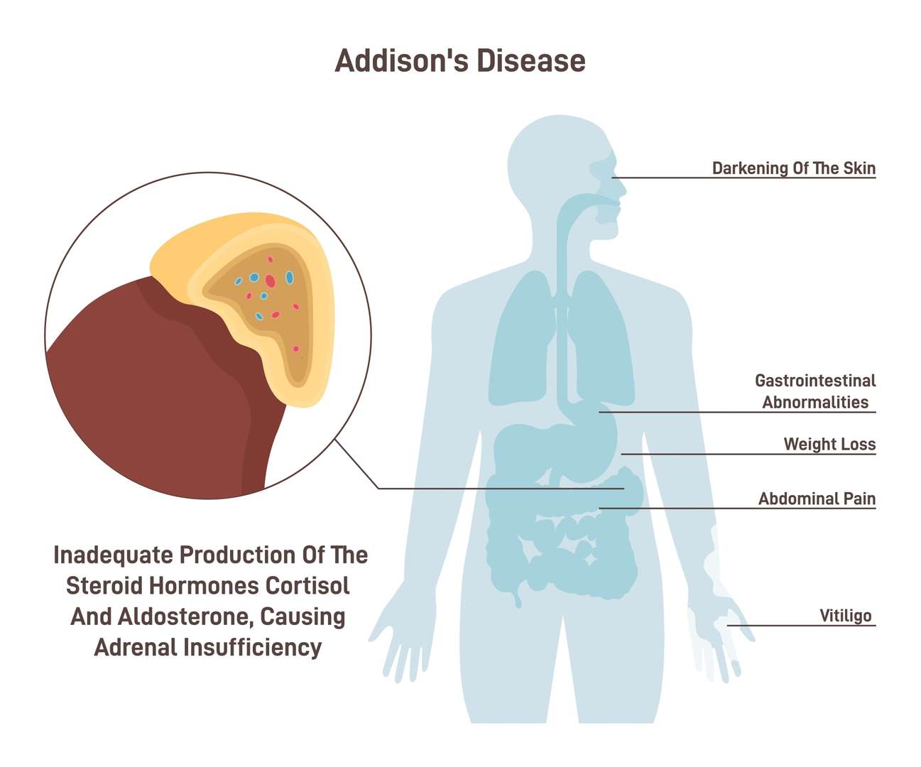 Addison Disease Testing and Analysis Services - Creative Diagnostics