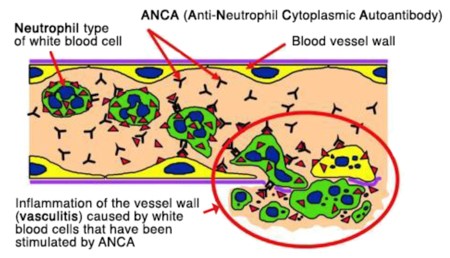 Anti-neutrophil cytoplasm antibodies, ANCAs - Creative Diagnostics