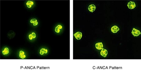 Anti-neutrophil cytoplasm antibodies, ANCAs - Creative Diagnostics