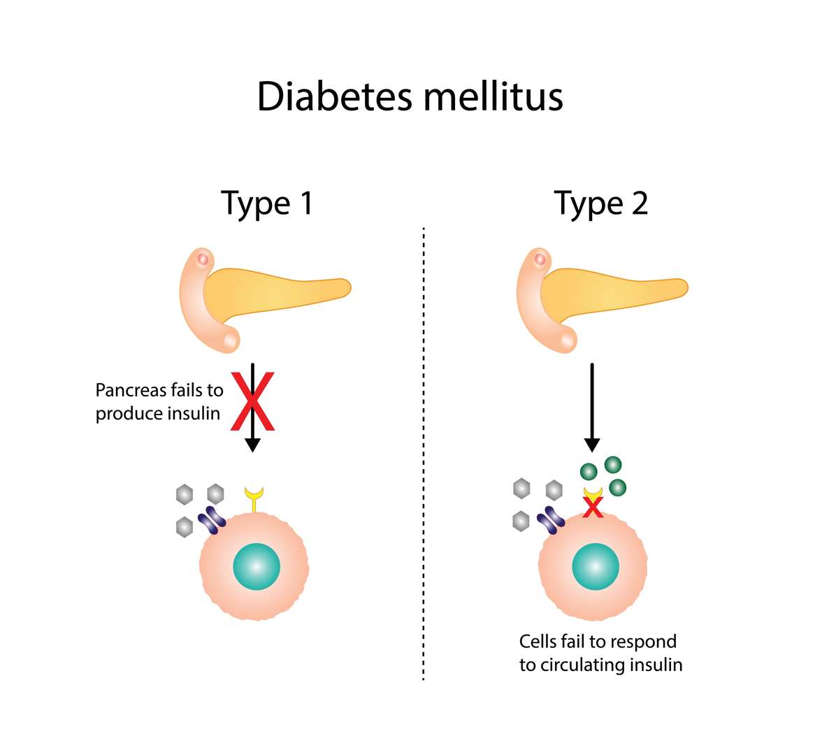 Autoimmune Diabetes Testing and Analysis Services - Creative Diagnostics