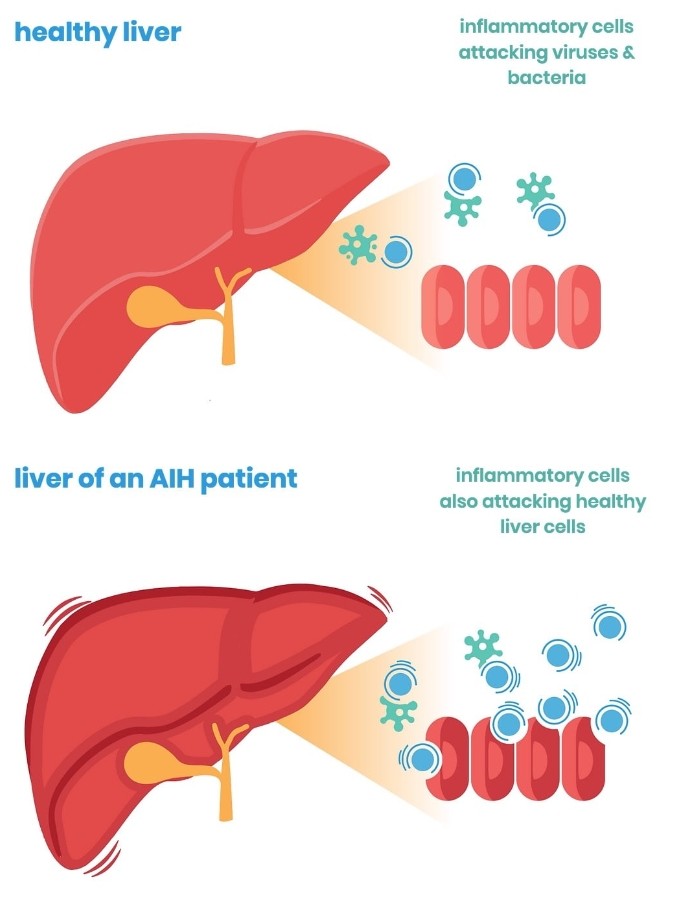 Autoimmune Hepatitis (AIH) - Creative Diagnostics