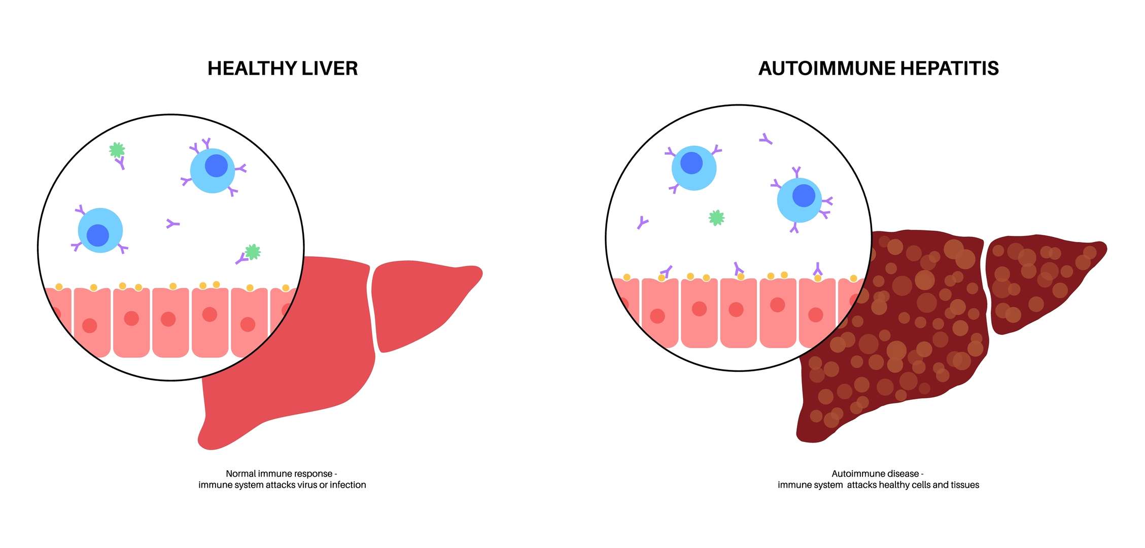 Autoimmune Liver Disease Biomarker Testing Services - Creative Diagnostics
