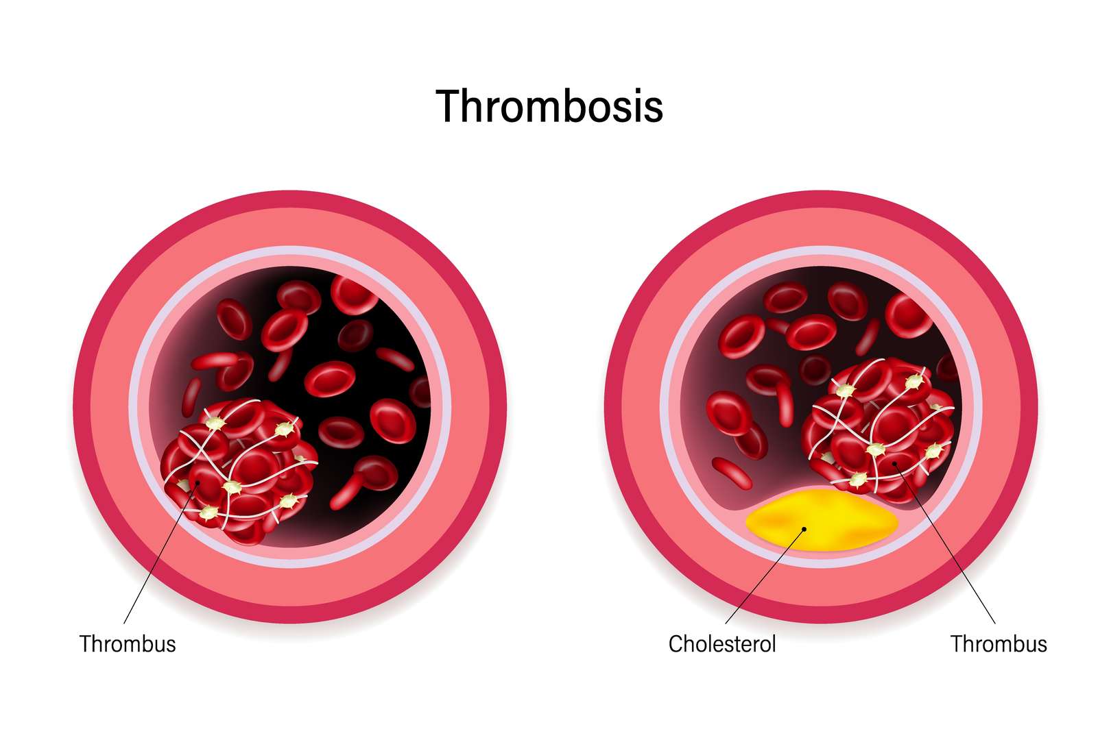 Autoimmune Thrombosis Testing and Analysis Services - Creative Diagnostics