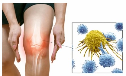 Bone Cancer - Creative Diagnostics