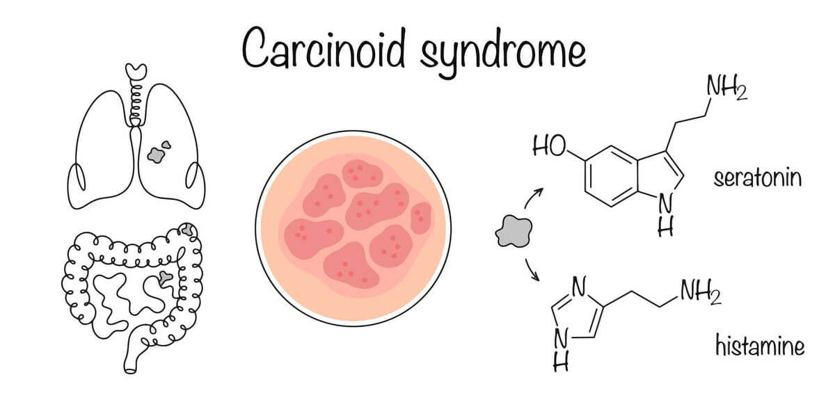 Carcinoid Tumors - Creative Diagnostics