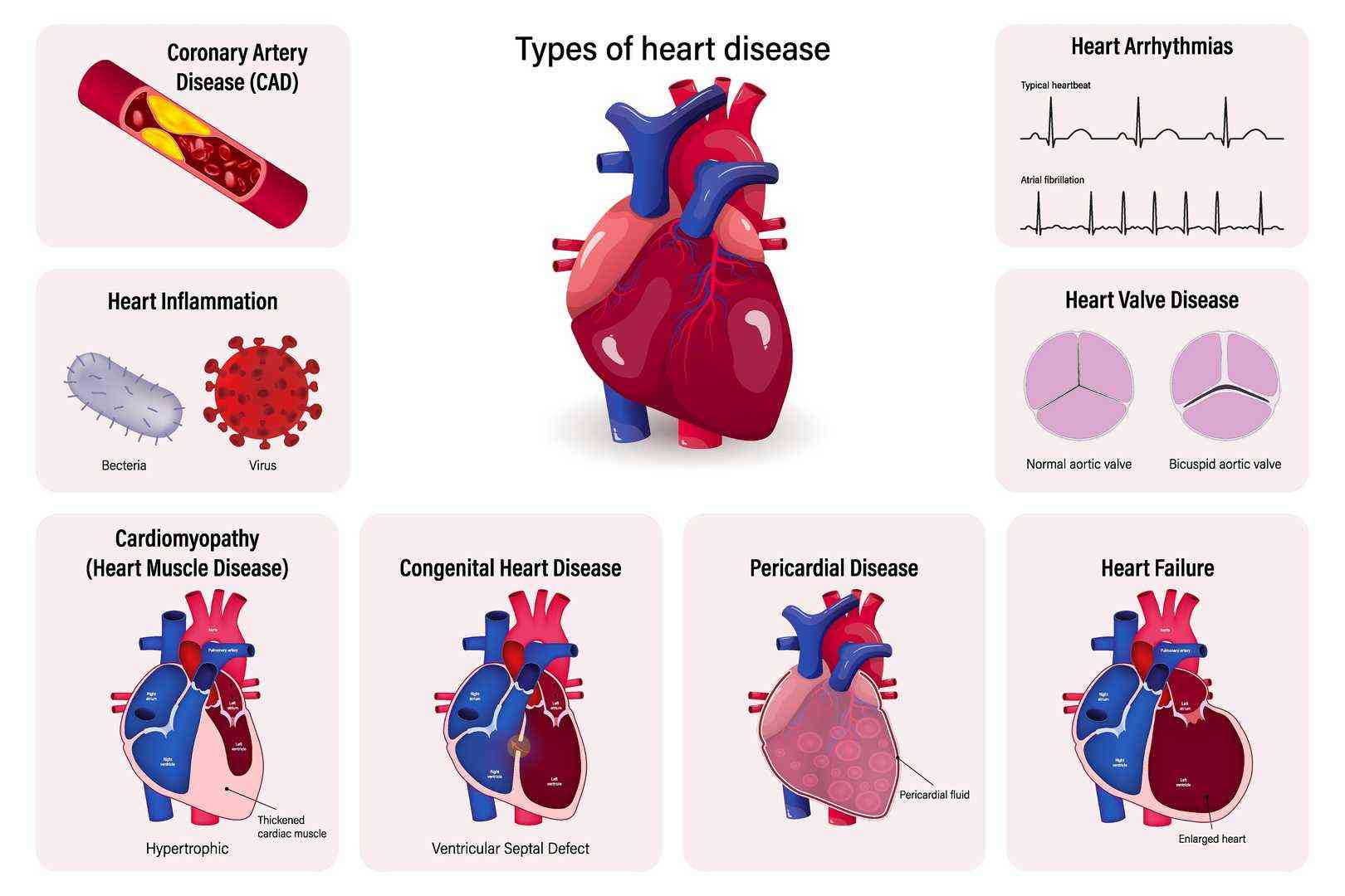 Cardiac Inflammation ELISA Kits for Clinical Research - Creative Diagnostics