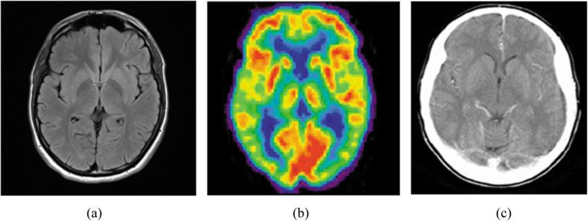 Alzheimer's Disease - Creative Diagnostics