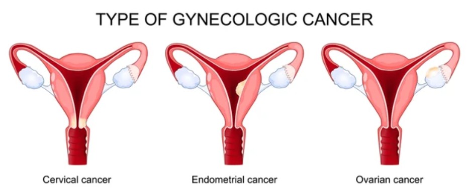 Endometrial Cancer - Creative Diagnostics