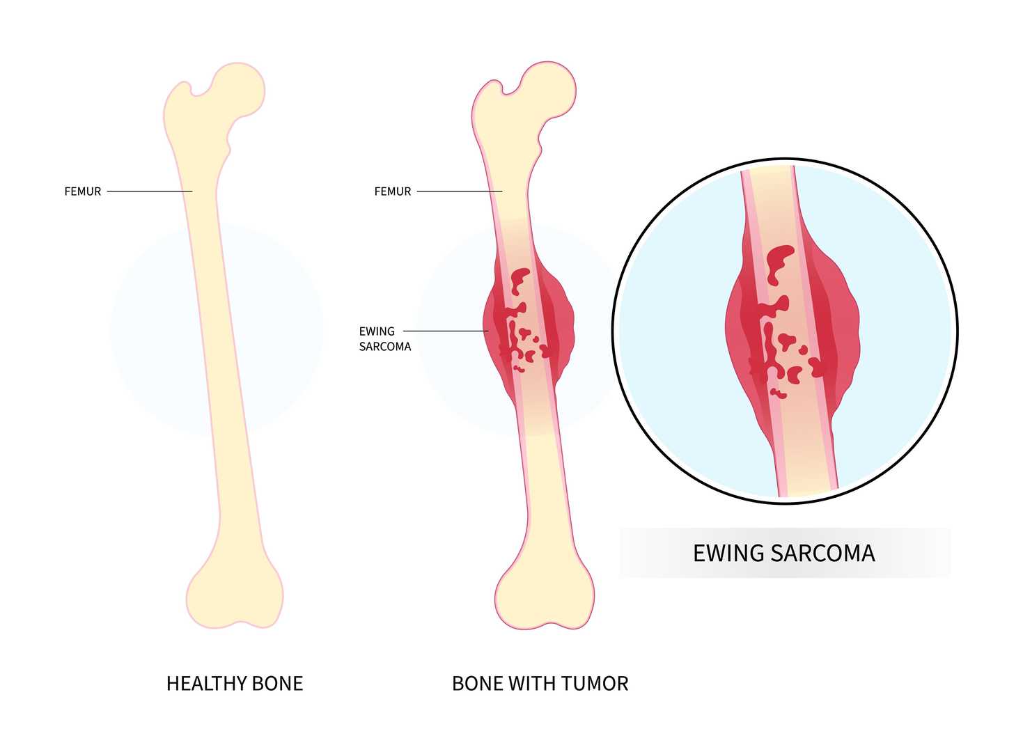 Ewing Sarcoma - Creative Diagnostics