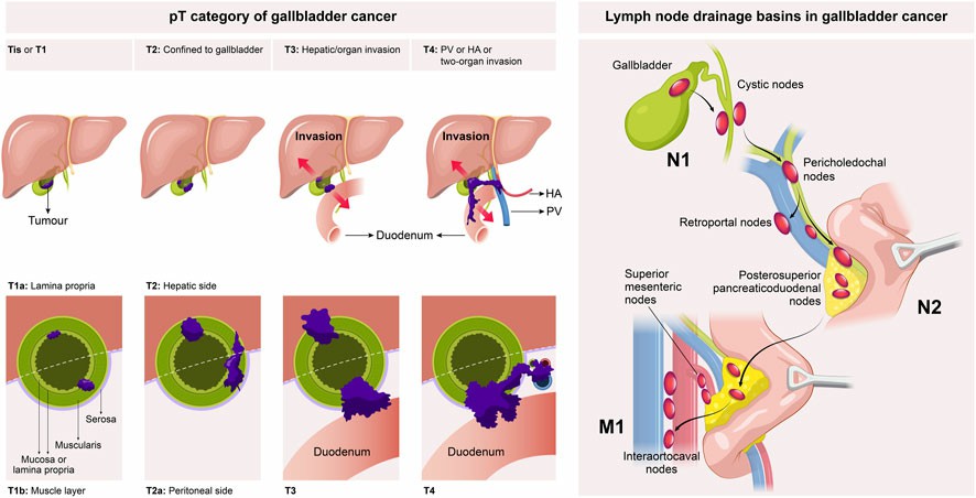 Gallbladder Cancer - Creative Diagnostics