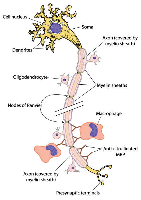 Multiple Sclerosis (MS) Testing - Creative Diagnostics