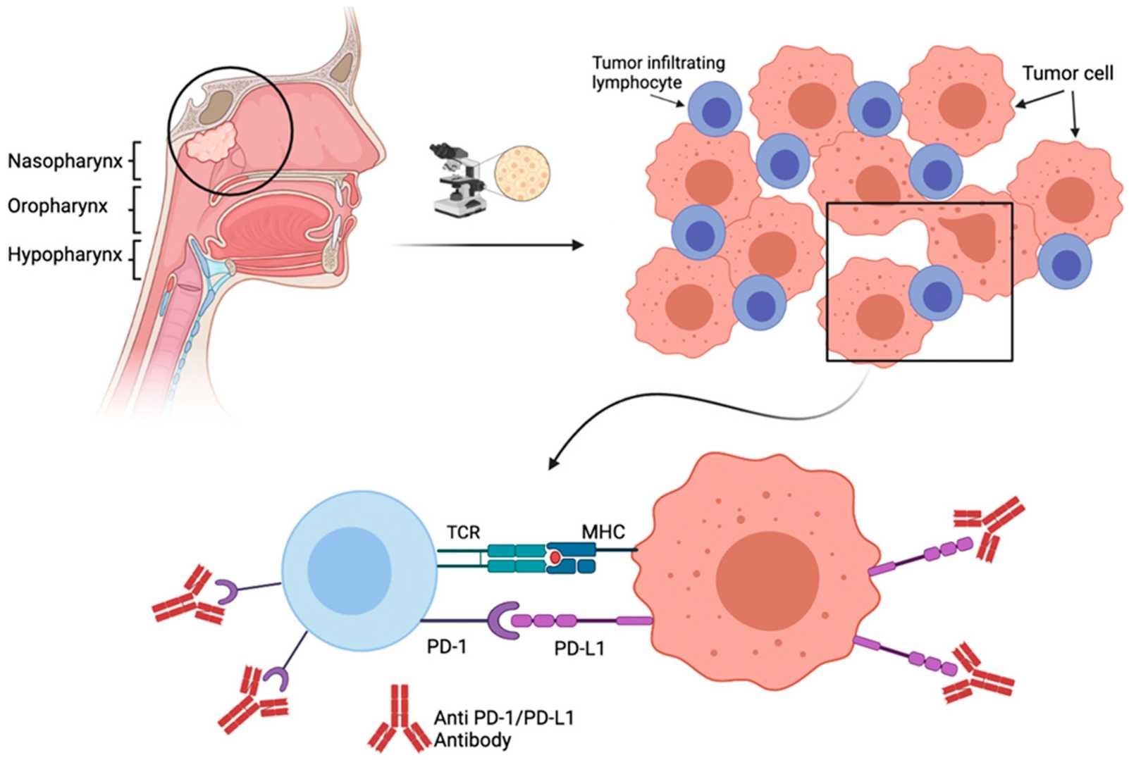Nasopharyngeal Carcinoma - Creative Diagnostics