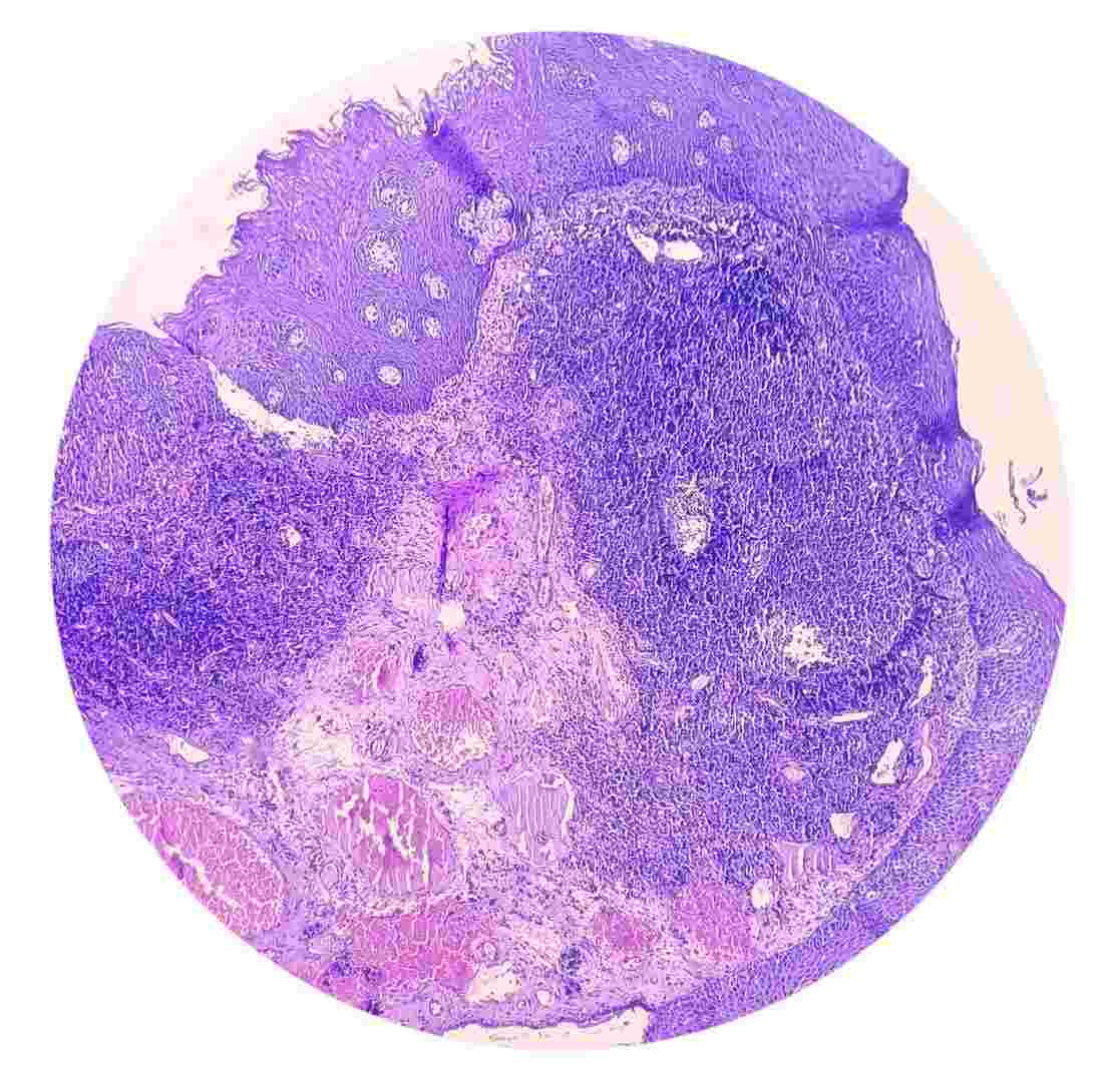 Neuroendocrine Tumors: Origin, Examination and Therapy - Creative ...
