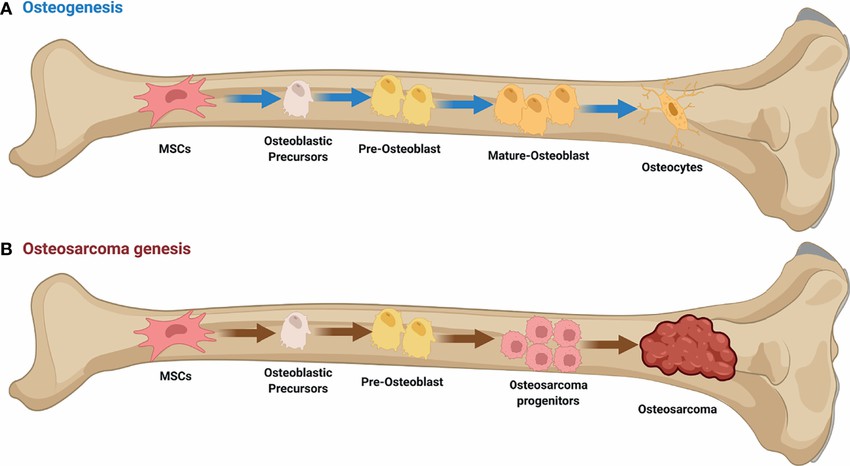 Osteosarcoma - Creative Diagnostics