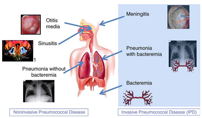 Pneumococcal Disease - Creative Diagnostics