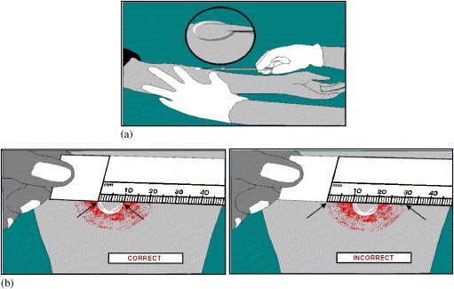 PPD Test for Tuberculosis - Creative Diagnostics