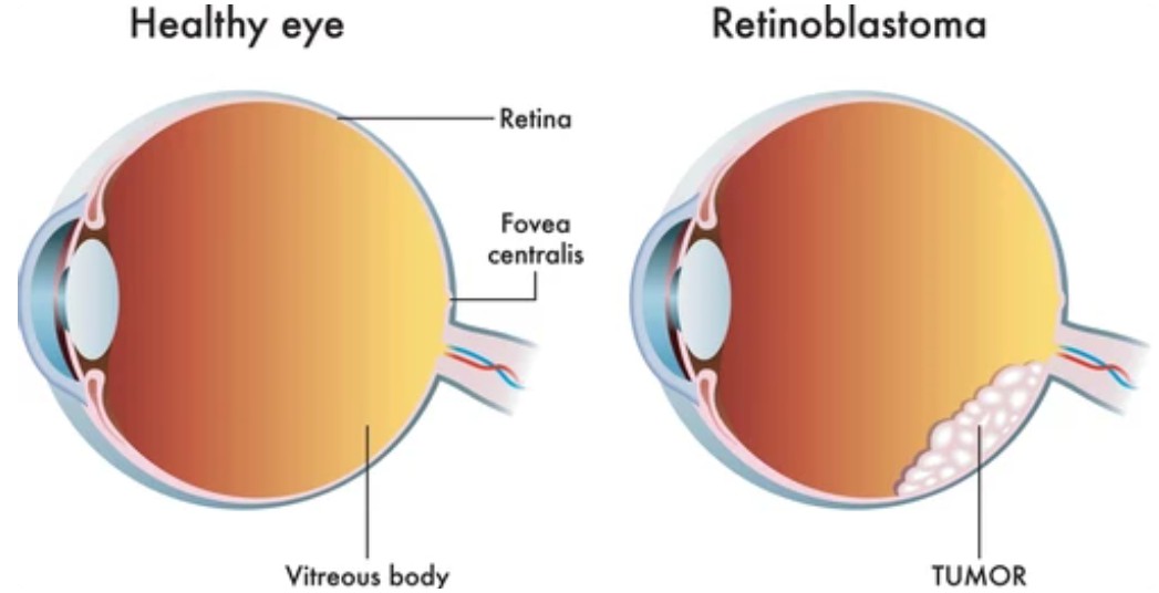 Retinoblastoma - Creative Diagnostics