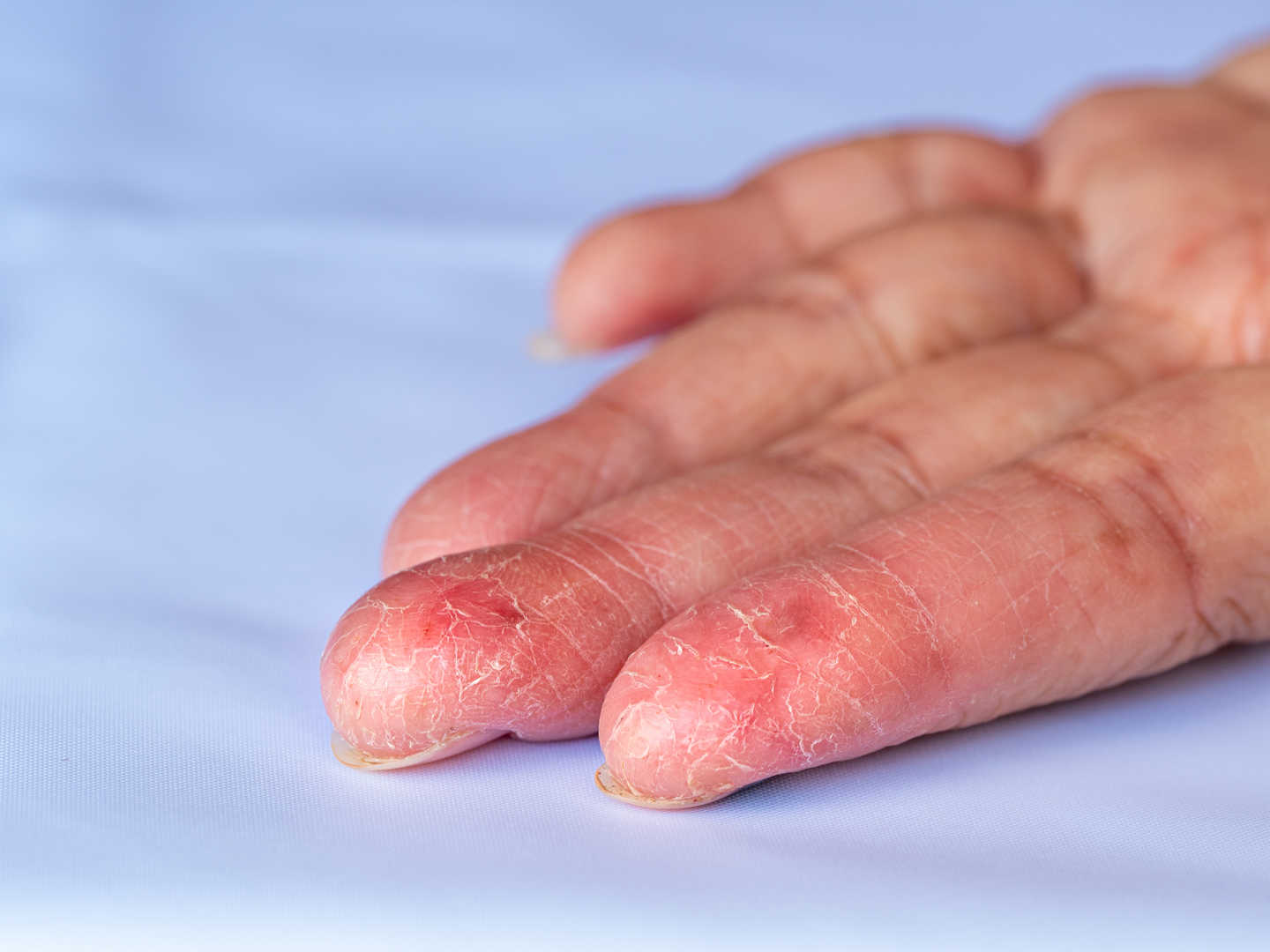 Systemic lupus erythematosus (SLE) Testing - Creative Diagnostics