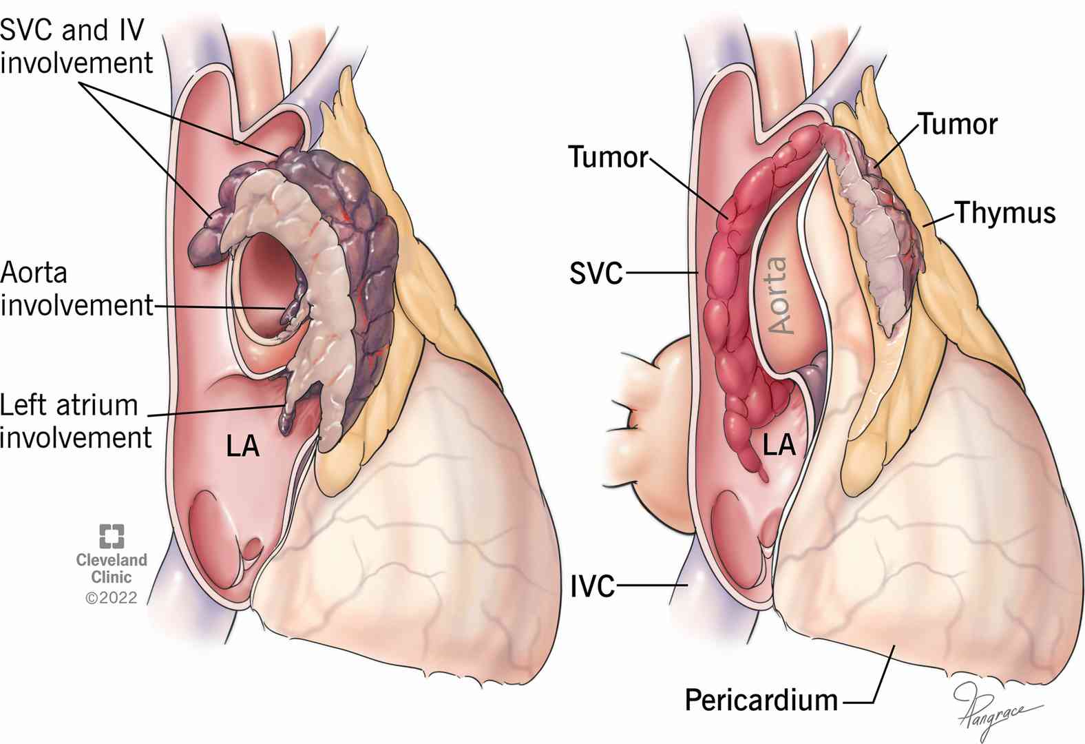 Thymoma - Creative Diagnostics
